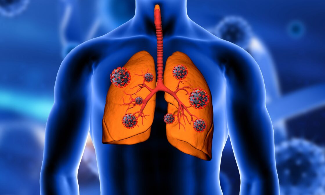 AINEs (antiinflamatorios no estereoideos): ¿qué son y cuál debes usar ...