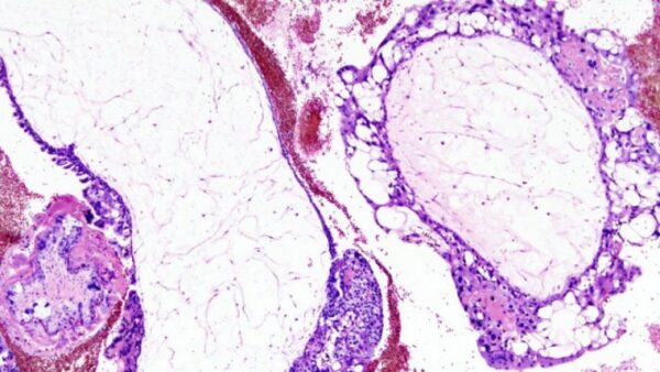 Mola hidatiforme (embarazo molar): qué es, síntomas y causas - Viviendo ...