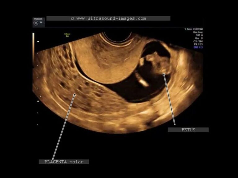 Mola hidatiforme (embarazo molar): qué es, síntomas y causas - Viviendo ...